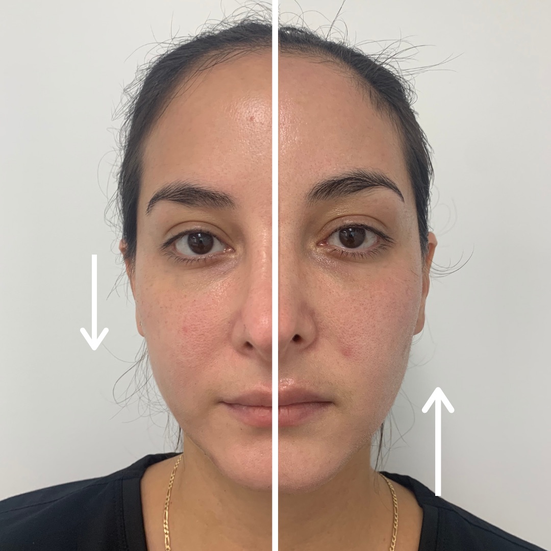 Glass Therapy in Burnaby | RMEDYᴹᴰ Aesthetics